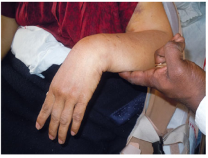 Radial Nerve Injury: Diagnosis and Treatment