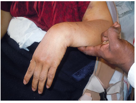 Radial Nerve Injury Diagnosis And Treatment